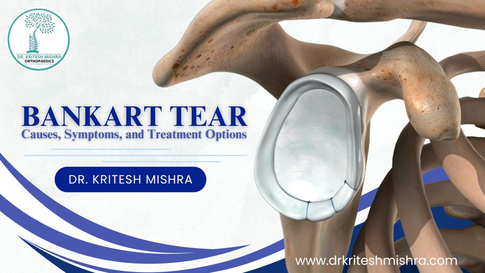 Bankart Tear: Causes, Symptoms, and Treatment Options – Dr. Kritesh Mishra