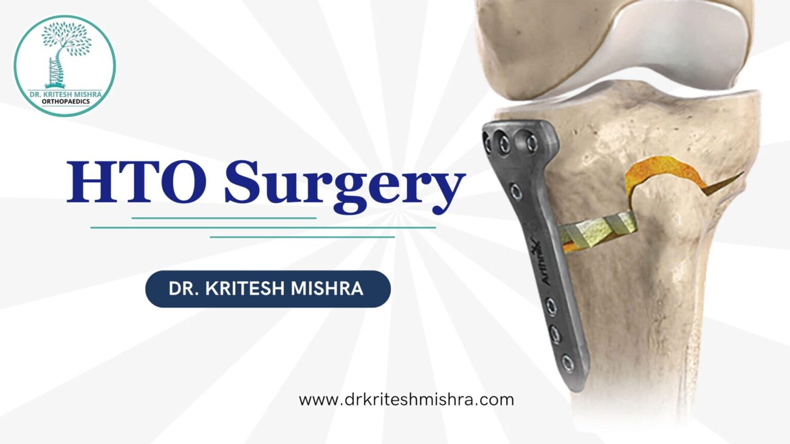 HTO Surgery: A Comprehensive Guide – Dr. Kritesh Mishra